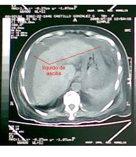 Diagnostico por Imagenes y la Ascitis Abdominal